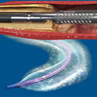 Can Drug-Coated Balloon plus Atherectomy Be a Successful Treatment for ...