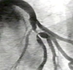 New "Y"-Shaped Stent Studied by Medtronic